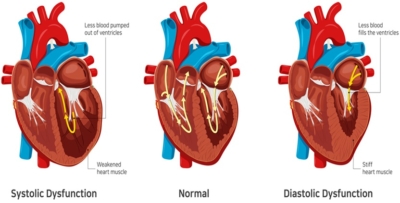 Heart failure: Clinical manifestations, Etiology, Risk factors ...